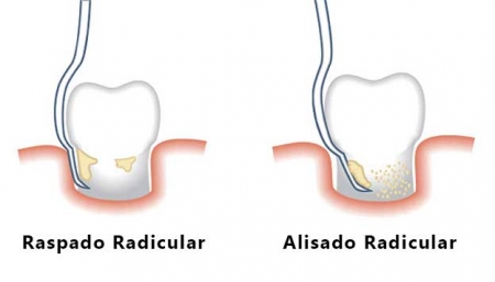Curetaje dental: Raspado y alisado radicular en Zaragoza